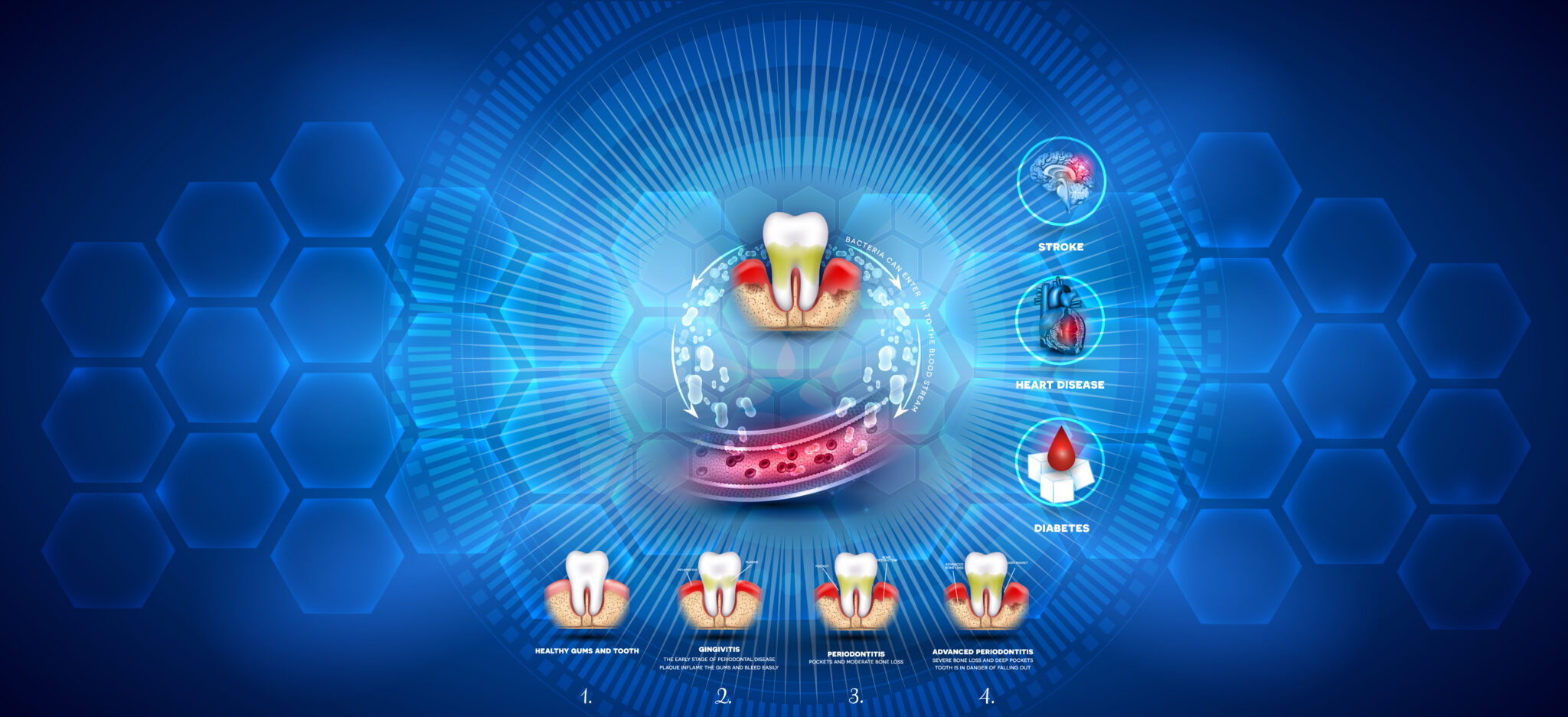 Periodontitis and Diabetes: How They Are Connected and Why It Matters ...